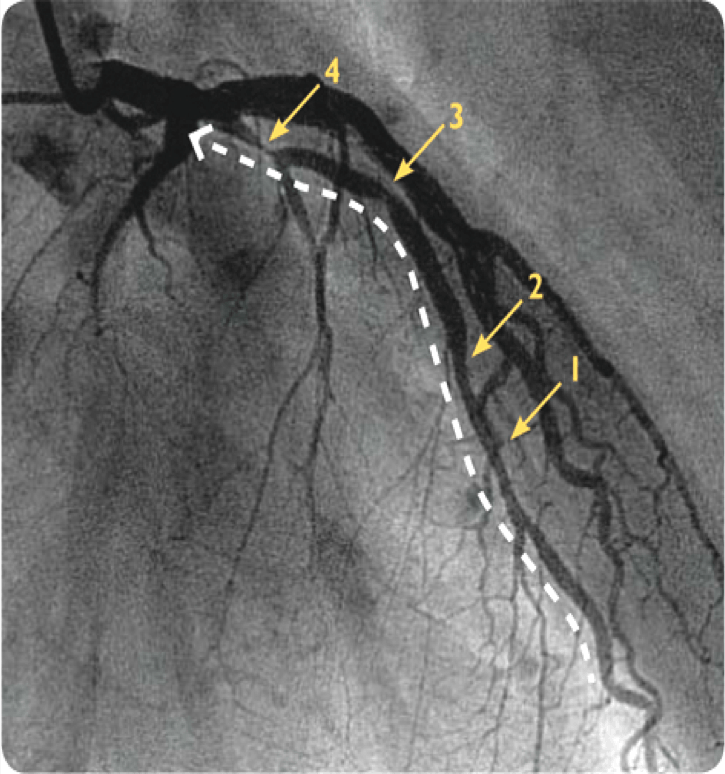 Coronary Pressure Wire Study - NM Cardiology, Dublin